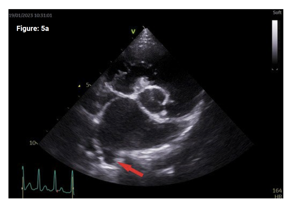 Staging of Preclinical Myxomatous Mitral Valve Disease in Primary ...